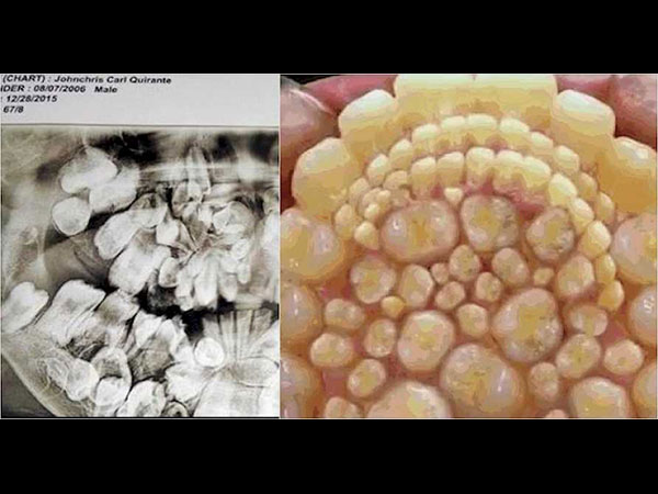 బాప్రే నమ్మలేని నిజం !! నోట్లో 232 అదనపు పళ్ళున్న యువకుడు ...