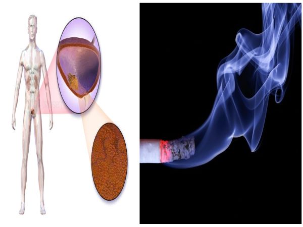 Smoking and Bladder Cancer: స్మోకింగ్ వల్ల బ్లాడర్ (మూత్రాశయ) క్యాన్సర్ ...