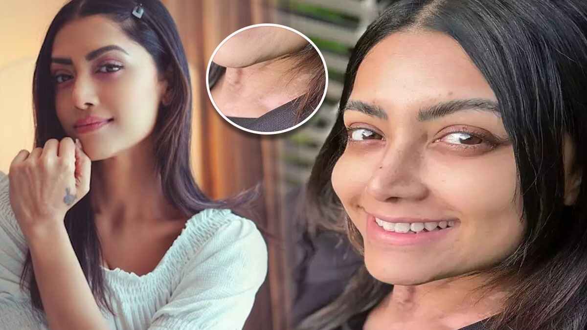 Mamta Mohandas: మమతా మోహన్‌దాస్‌కు బొల్లి వ్యాధి, ఎందుకొస్తుంది ...