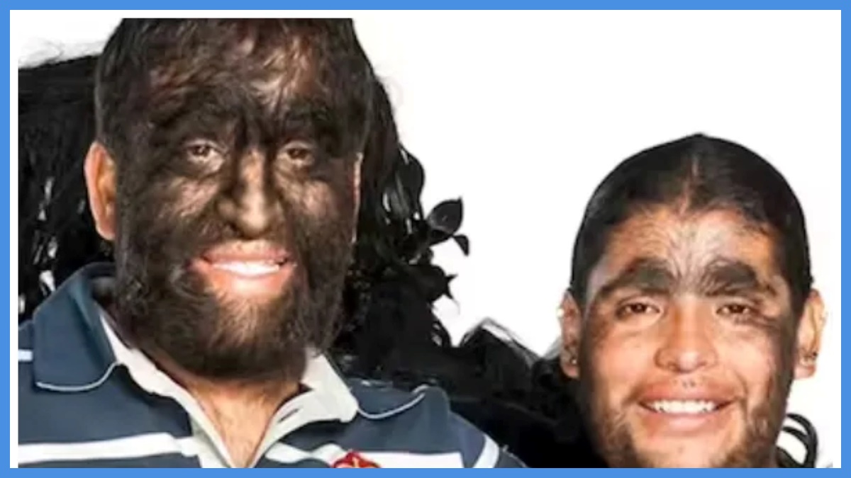 గిన్నిస్ బుక్ లో చోటో సంపాధించిన Werewolf syndrome కుటుంబం మొత్తం ...